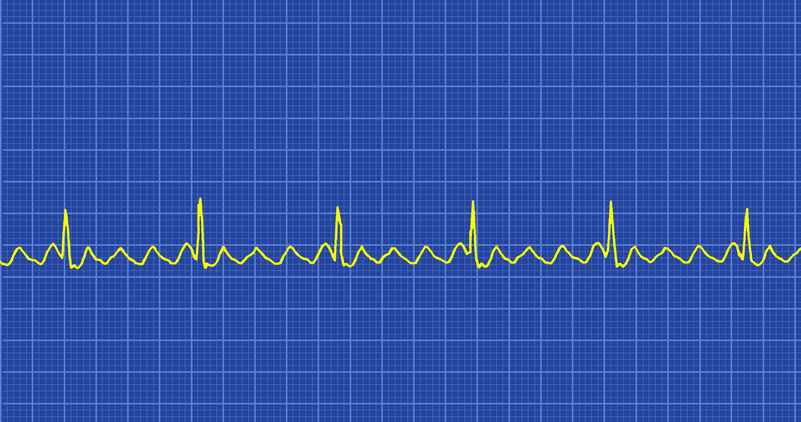 Master Acls Algorithms Complete Acls Reviewpass Your Acls Course With No Stress → Atrial